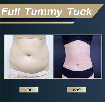 Full Tummy Tuck & Mini Tummy Tuck ตัดหนังหน้าท้องมีกี่แบบ - TigerHappy
